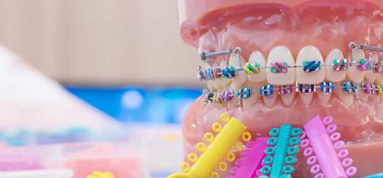 Berikut Tips Memilih Warna Karet Behel